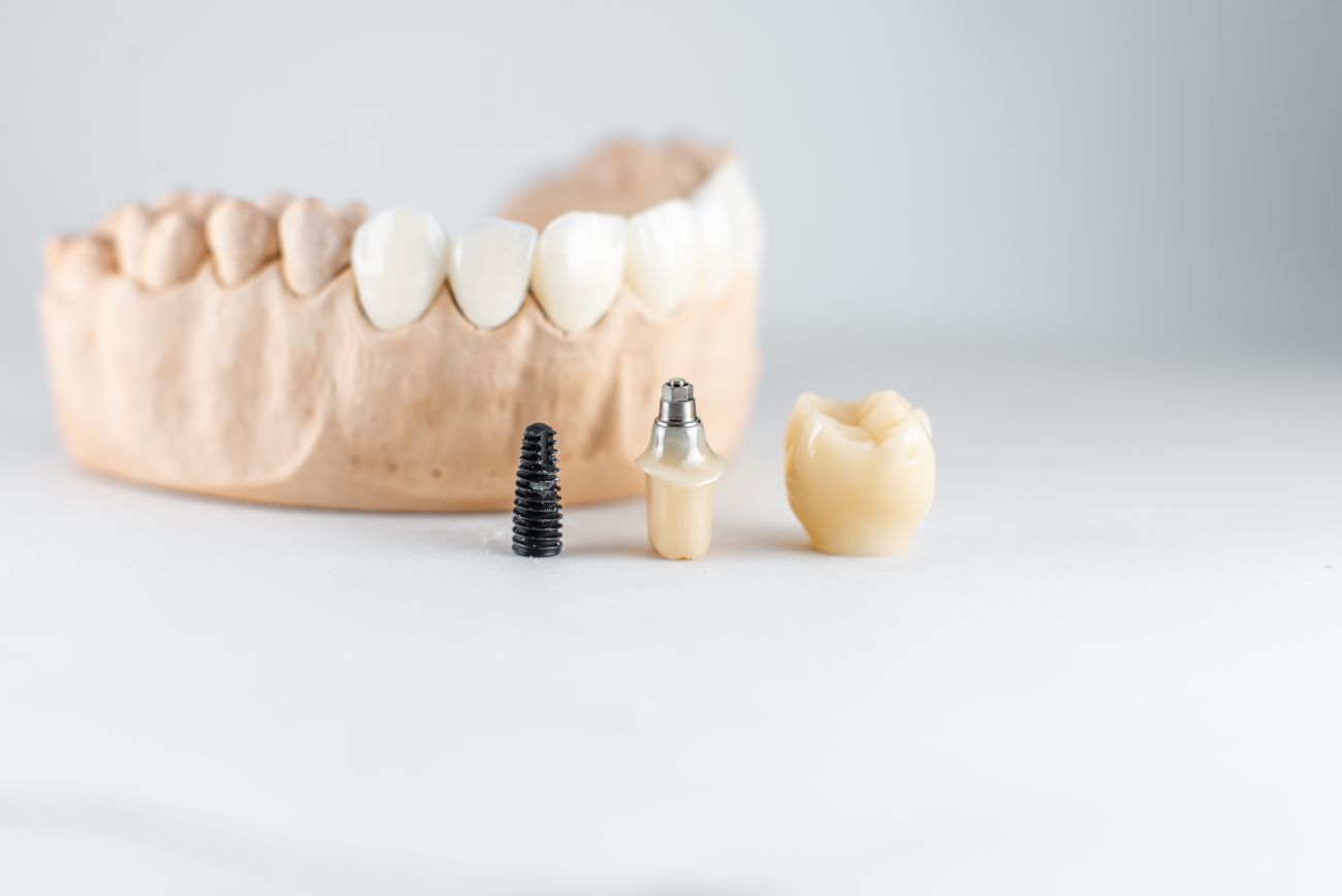 Braki w uzębieniu – jakie są opcje? | MultiPoradnik